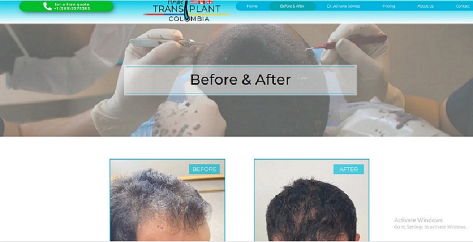 The Future of Hair Transplant Technology: What to Expect