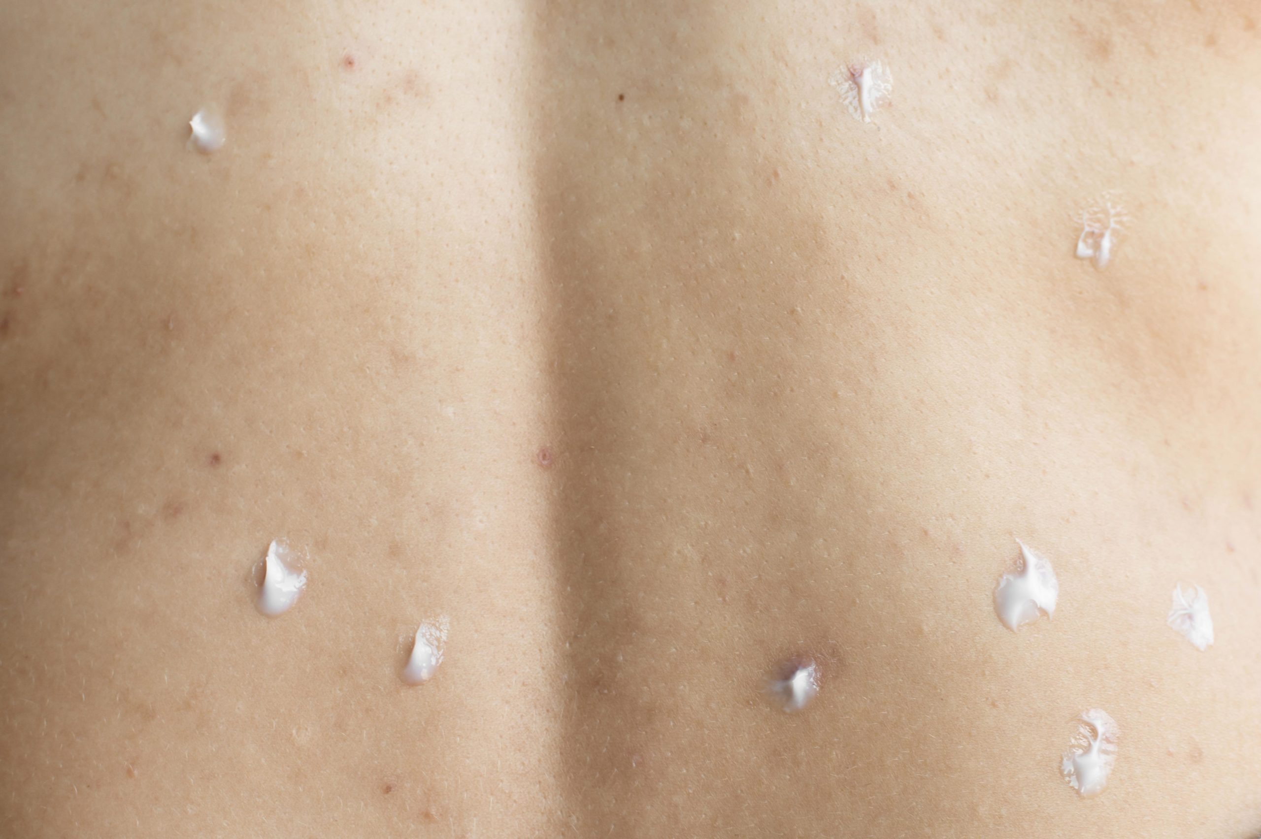 The Future of Dermal Delivery Devices in Cosmetic Dermatology