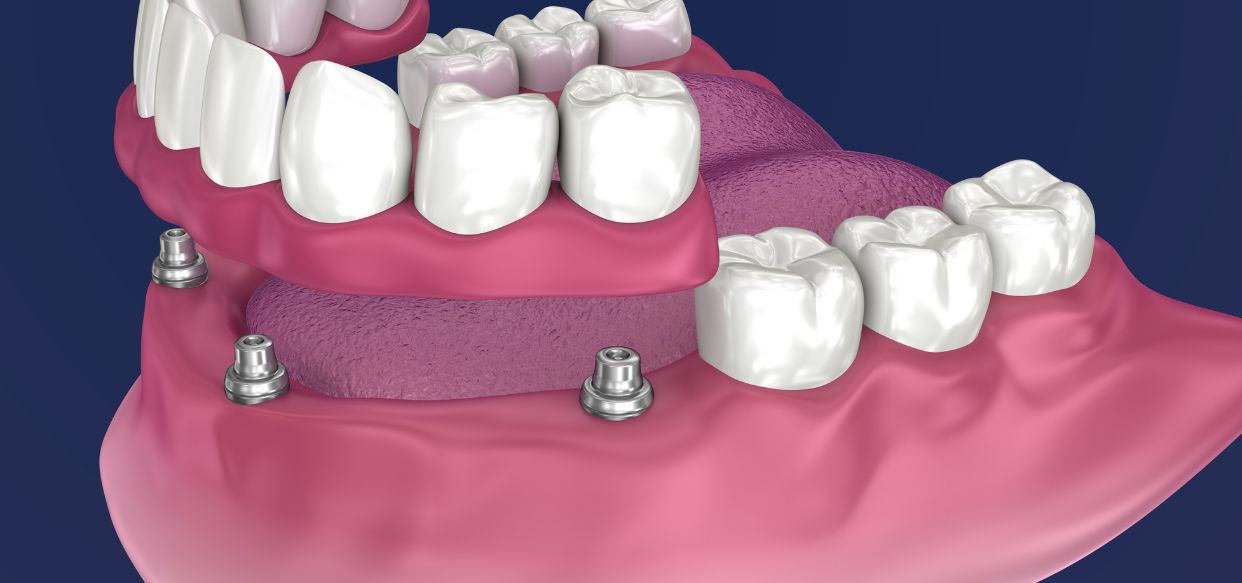 Missing Most Lower Teeth? Keep the Remaining Ones or Go All-on-X? (A ...