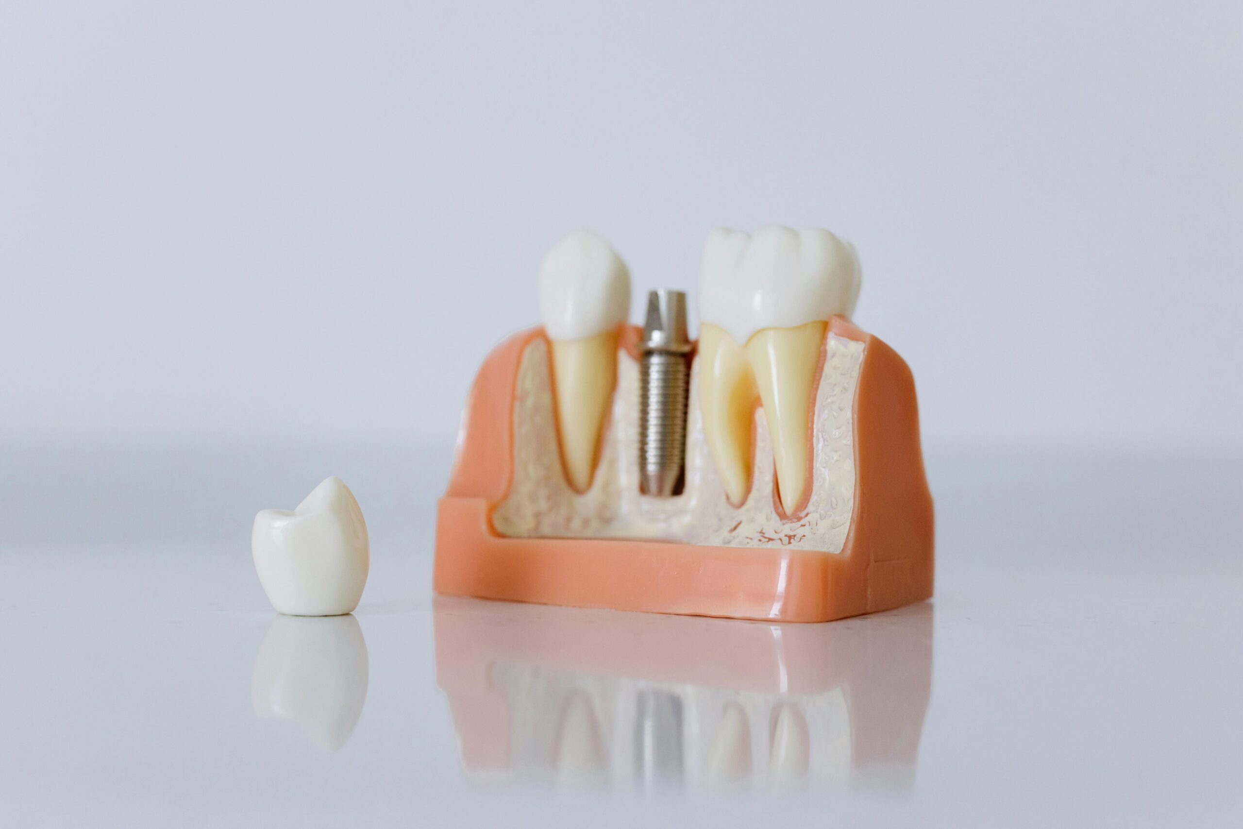 Restore Your Smile with High-Quality Dental Implants
